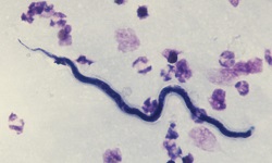 Onchocerca volvulus - Life Cycle, Pathogenesis, Pathology