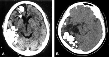Paragonimus westermani - Laboratory Diagnosis, Treatment, Prevention ...